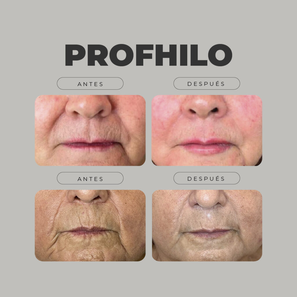 Profhilo en Madrid: Hidratación y Bioestimulación Facial | Care Me 360